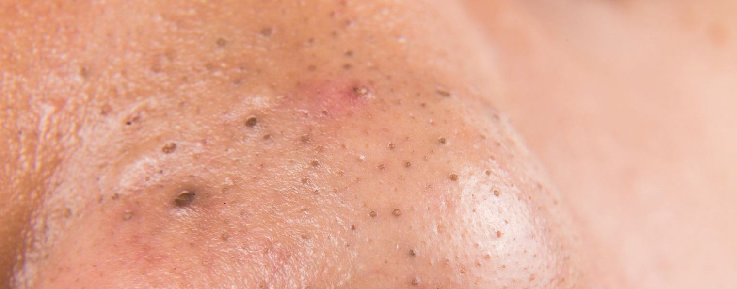 Жизнь без прыщей