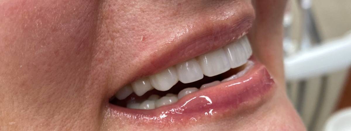 Неватекс.Москва - All-On-4 / All-On-6