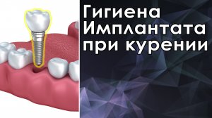 Долгосрочный уход за имплантатами у курильщика
