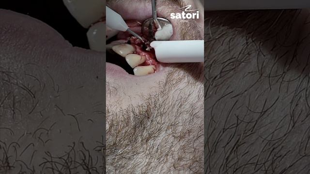 Резекция верхушки корня зуба / удаление кисты #стоматология #зубы#доктор