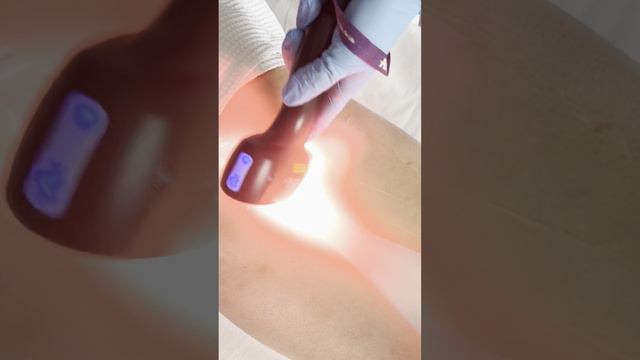 Эпиляция лазером SOPRANO TITANIUM | 3 лазера в одном! | Быстро, без боли и навсегда | клиника GEN87