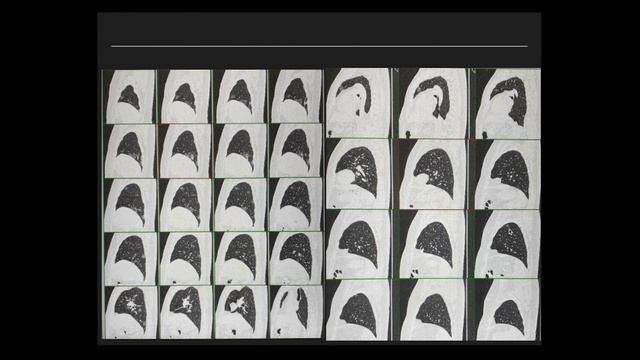 CORADS and CT Severity score what every Covid warrior should know ...