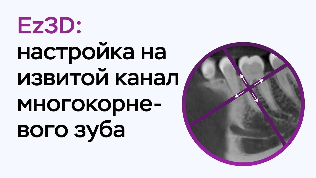 Возможности программы Ez3D: настройка на извитой канал многокорневого зуба