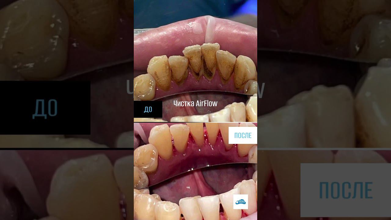 Не увидели ! #гигиенаполостирта #зубы #доктор #beautymakeup #dentist #протезированиезубов #улыбка
