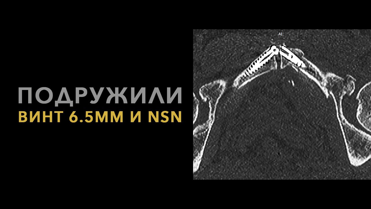Подружили Винт 6.5мм и NsN