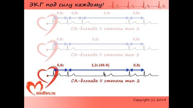 Урок 6. Видеокурс ЭКГ под силу каждому.
