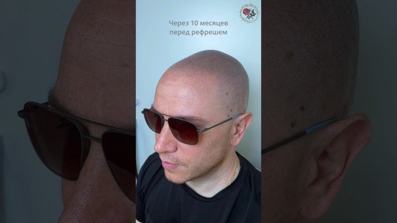 Перед освежением цвета, трихопигментация через 10 месяцев. Нет лысине. Scalp tattoo Smp