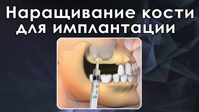 Курс Ильгама Уразбахтина_ закрытый синус-лифтинг