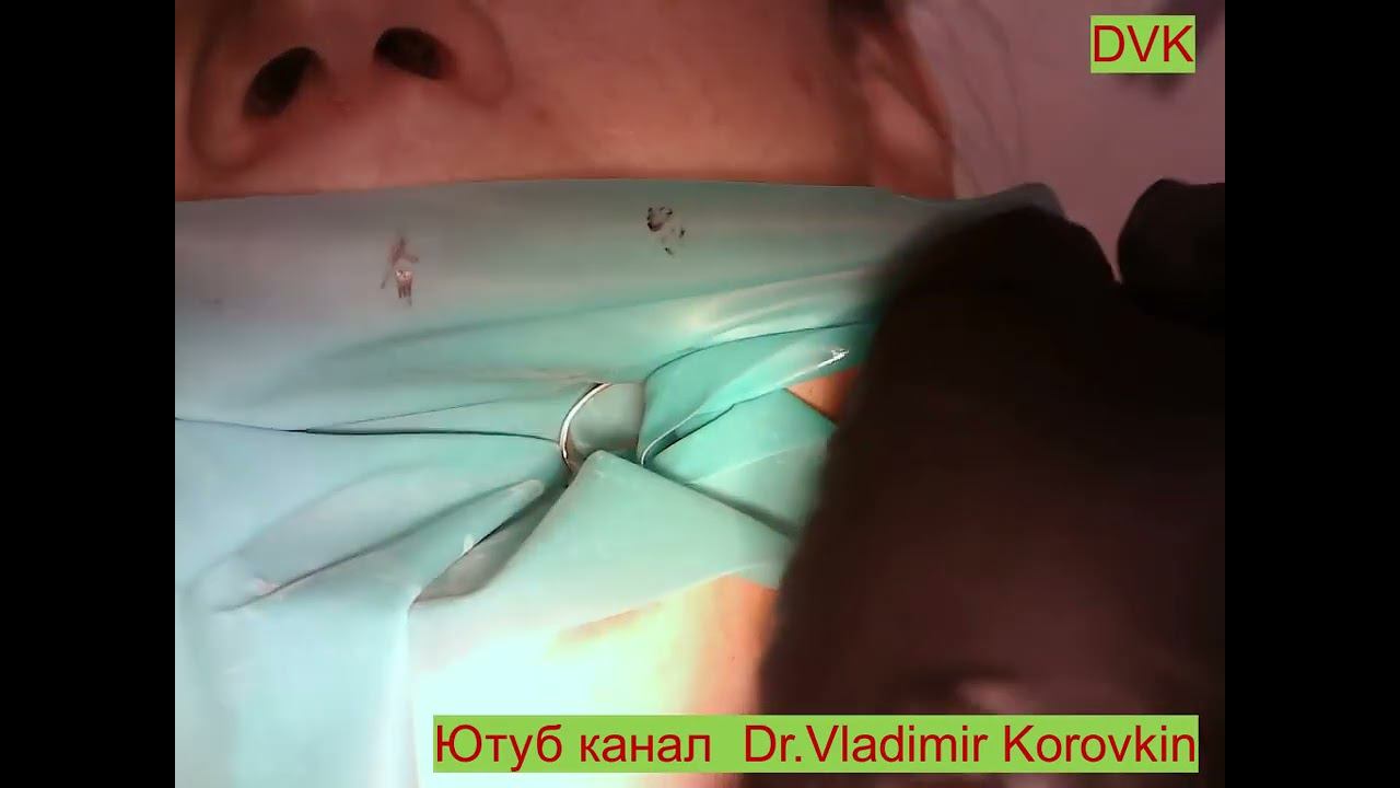 Одиночная изоляция #Rubberdam 38 зуба .  Платок Dispodent.