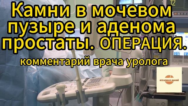 Камни в мочевом пузыре и аденома простаты. Комментарий врача уролога. #health