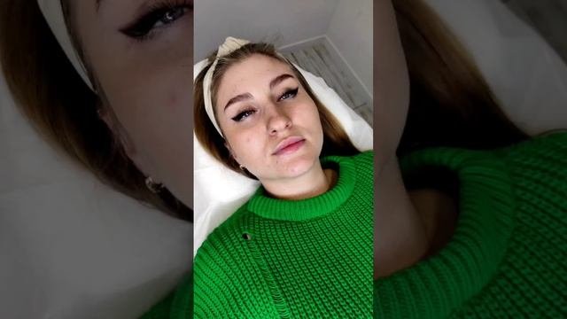 Увеличение губ в технике "Russian lips"