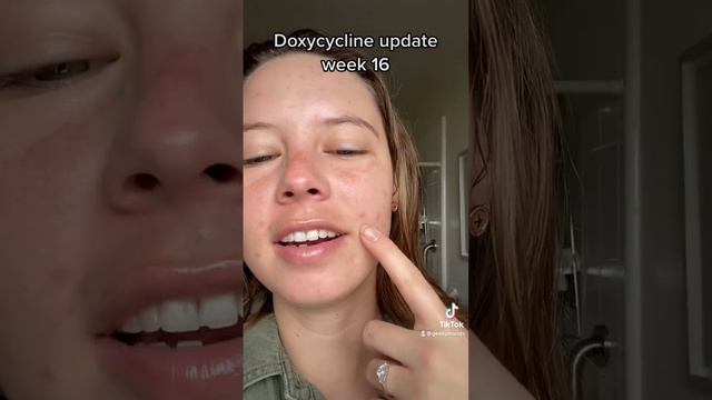 Doxycycline Update Week 16 | my doxycycline journey