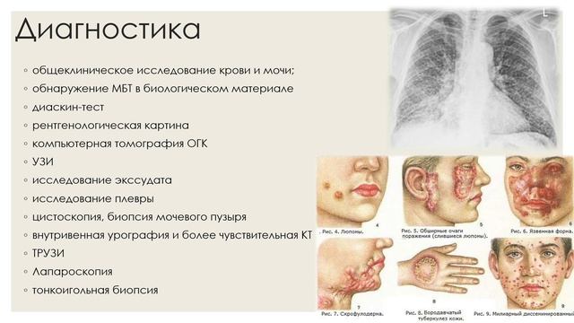 8. Инфекционная патология ч2(Диагностика туберкулеза).mp4