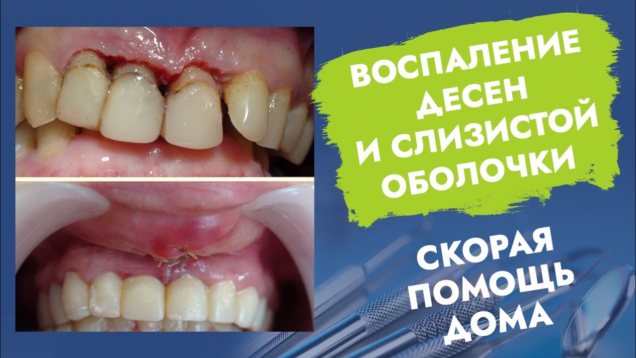 Воспаление во рту. Что делать?