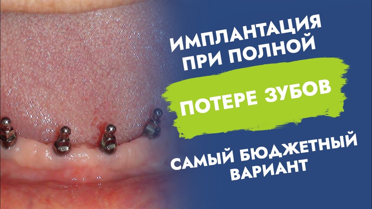 Имплантация при полной потере зубов. Самый бюджетный вариант.