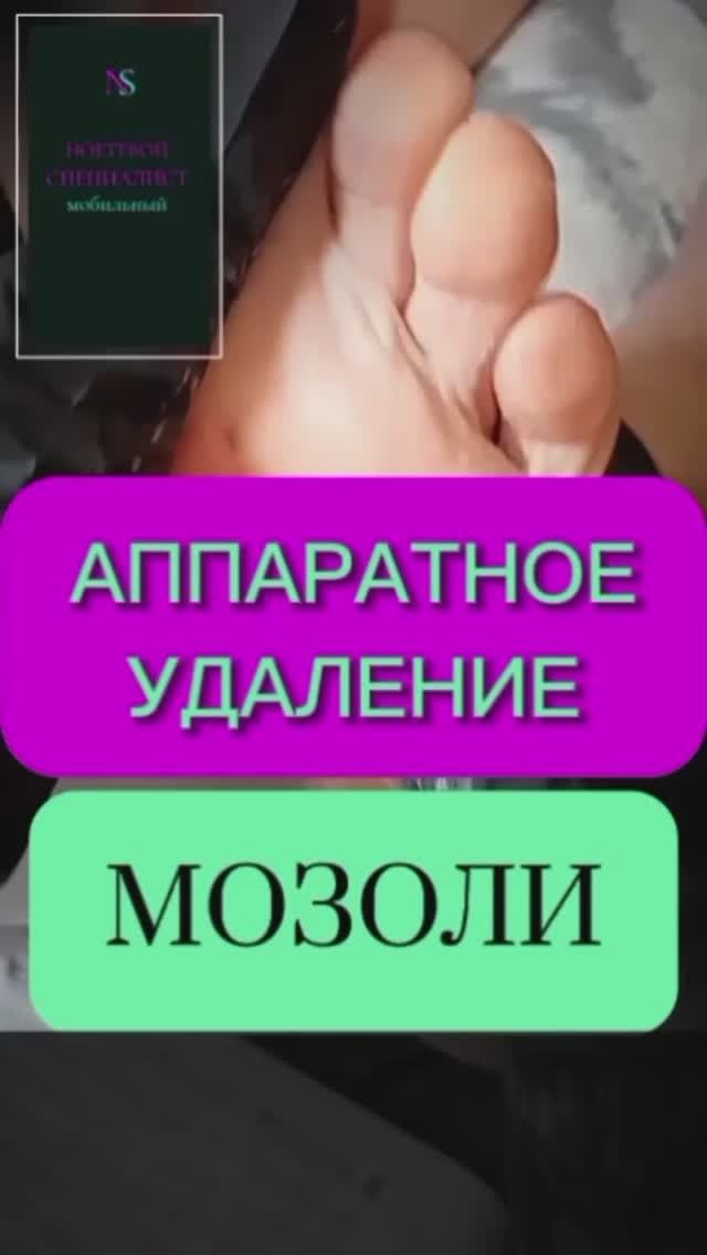 1 - Удаление мозолей.
2 - Правильная домашняя обувь.