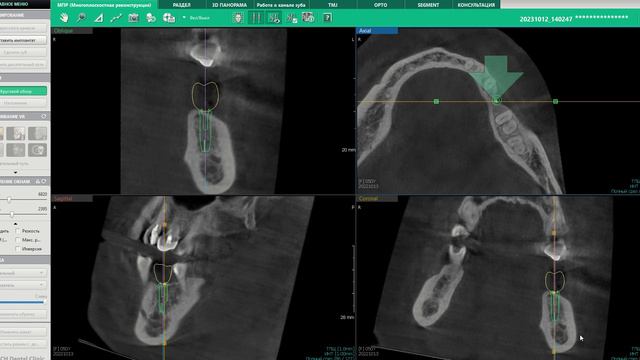 Круговой обзор вокруг импланта