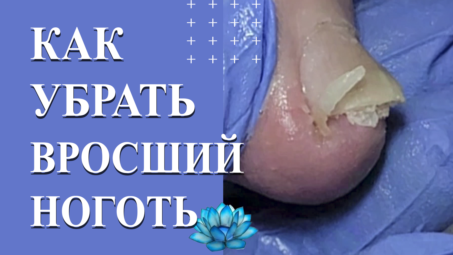 Онихолизис ногтей на ногах. Лечение вросшего ногтя. Скоба фрезера.