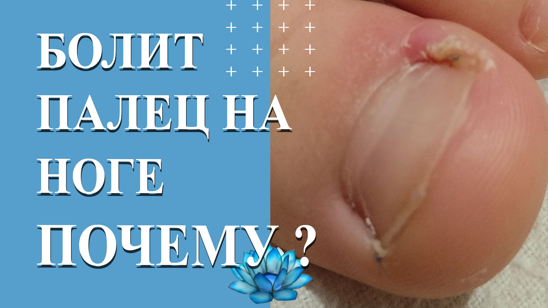 Вросший ноготь у ребёнка. Удаление вросшего ногтя.