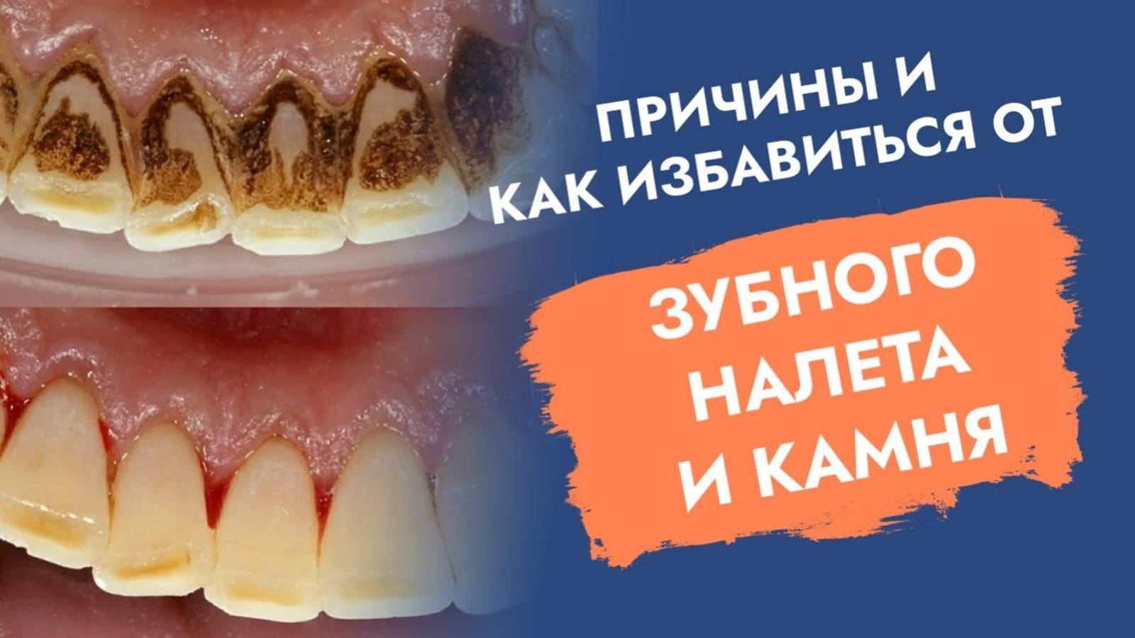 Причины зубного налёта и камня и способы избавления от них.