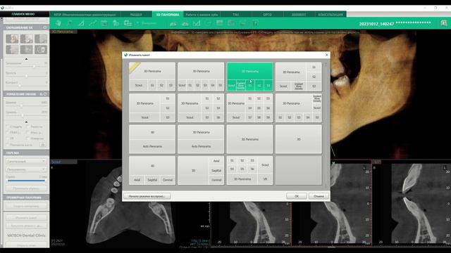 Плотность кости вокруг виртуально установленного импланта