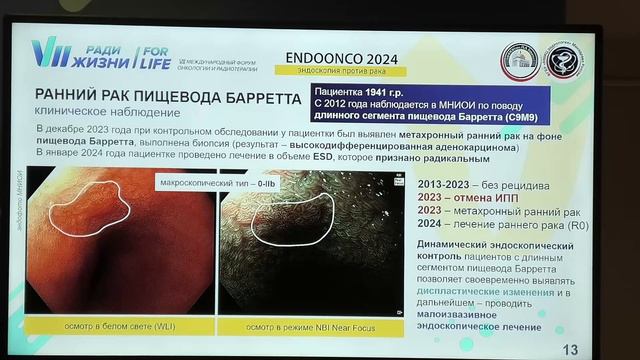 2024 09 18 04 Рябцева ВИ Рак пищевода Барретта 15-летний опыт МНИОИ им. П.А. Герцен