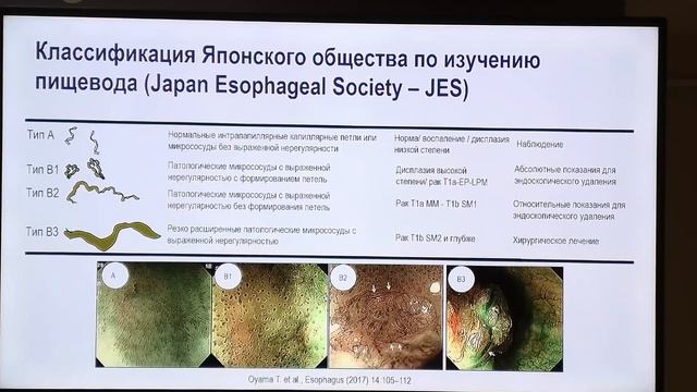 2024 09 18 02 Куваев РО Возможности современной эндоскопии в диагностике раннего плоскоклеточногора