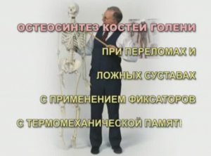 Остеосинтез костей голени при переломах и ложных суставах с применением фиксаторов с памятью формы