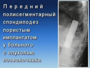 Две операции при опухолях позвоночника