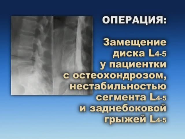 Операция - замещение пористым имплантатом межпозвонкового диска LIV-LV у пациентов с остеохондрозом