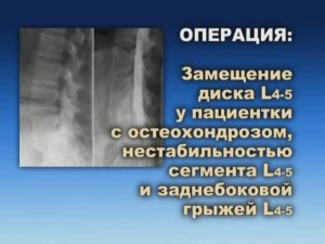 Операция - замещение пористым имплантатом межпозвонкового диска LIV-LV у пациентов с остеохондрозом