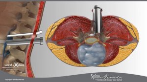 Lumbar Microdiscectomy - Spine Center Northern Nevada, Northern California - Spine Surgery