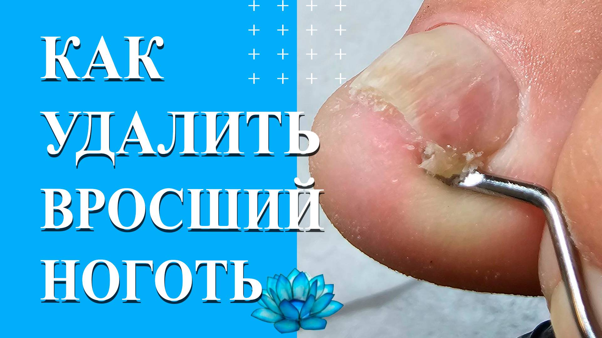 Вросший ноготь на ноге. Удаление вросшего ногтя.