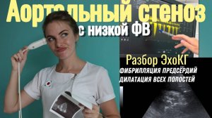 Эхокардиография. Разбор случая с АОРТАЛЬНЫМ СТЕНОЗОМ, низкой ФВ, ФП, ДИЛАТАЦИЕЙ всех полостей.