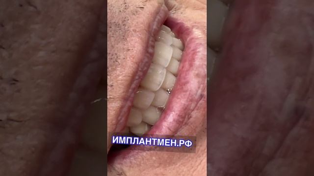 Постоянный керамокомпозитный протез устанавливается сразу и включен в стоимость операции All-On-4