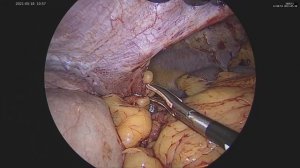 Лапароскопическая пластика диафрагмы.