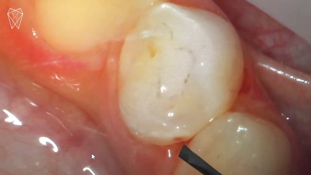 Лечение кариеса. Клинический случай в Belgravia Dental Studio