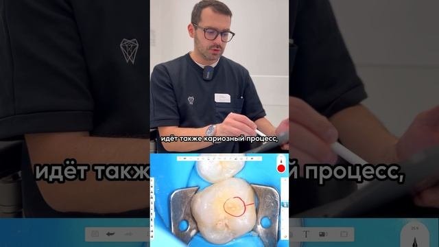 ⚕️ Лечение кариеса без наркоза у стоматофоба. Клинический случай
