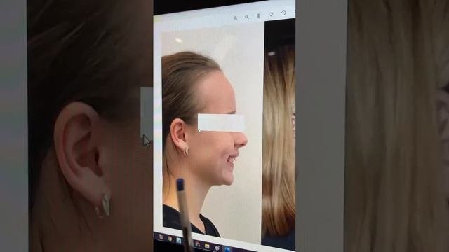 Ортодонтическое лечение. Клинический случай