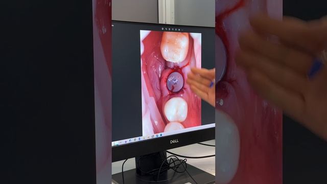 Удаление зуба с коронкой и одномоментная имплантация. Клинический случай