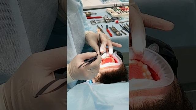 ⚕️ Имплантация и удаление зуба за 1,5 часа