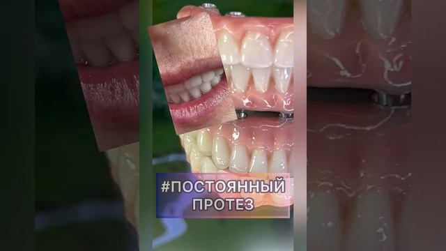 Постоянный керамокомпозитный протез обе челюсти сразу после операции All-On-4. Неватекс отзывы