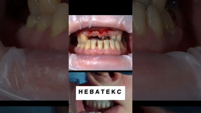 До и После операции All-On-4 - Постоянный протез устанавливается сразу и включен в стоимость