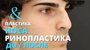 Ринопластика у мужчин - это особый подход!