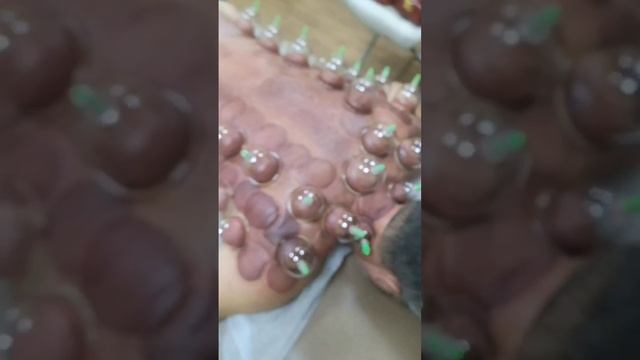 Банки массаж Нижегородский Костоправ 89870878785 #банкимассаж@kostoprav52