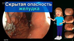 Метастазы меланомы кожи в желудке | Клинический случай
