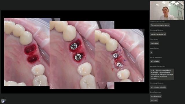 03. Особенности применения технологий Clot-PRF и Liquid-PRF