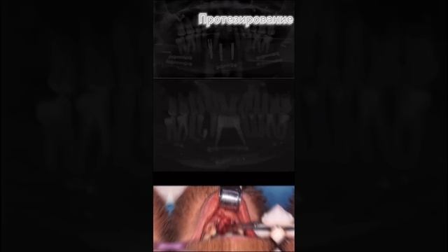 Язык не помещался во рту, удалили миксому