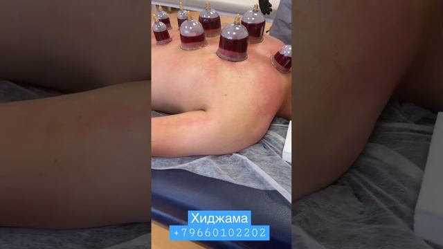 Хиджама в Москве
