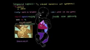 What is congenital syphilis? | Infectious diseases | NCLEX-RN | Khan Academy